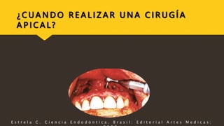 Cirugía Apical paso a paso, procedimiento dental | PPTX