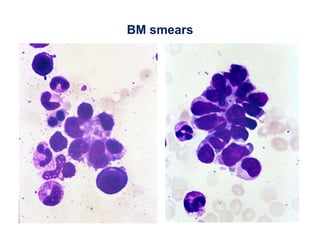 Cytogenetic Analysis in Hematological Malignancies | PPTX