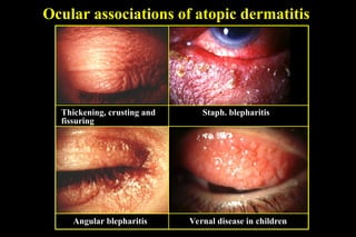 Eyelid disease lectures MBBs 4th year Students | PPT