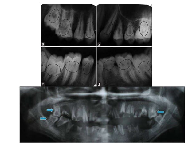 03 DISORDERS OF DEVELOPMENT OF TEETH AND CRANIOFACIAL ANOMALIES.pptx
