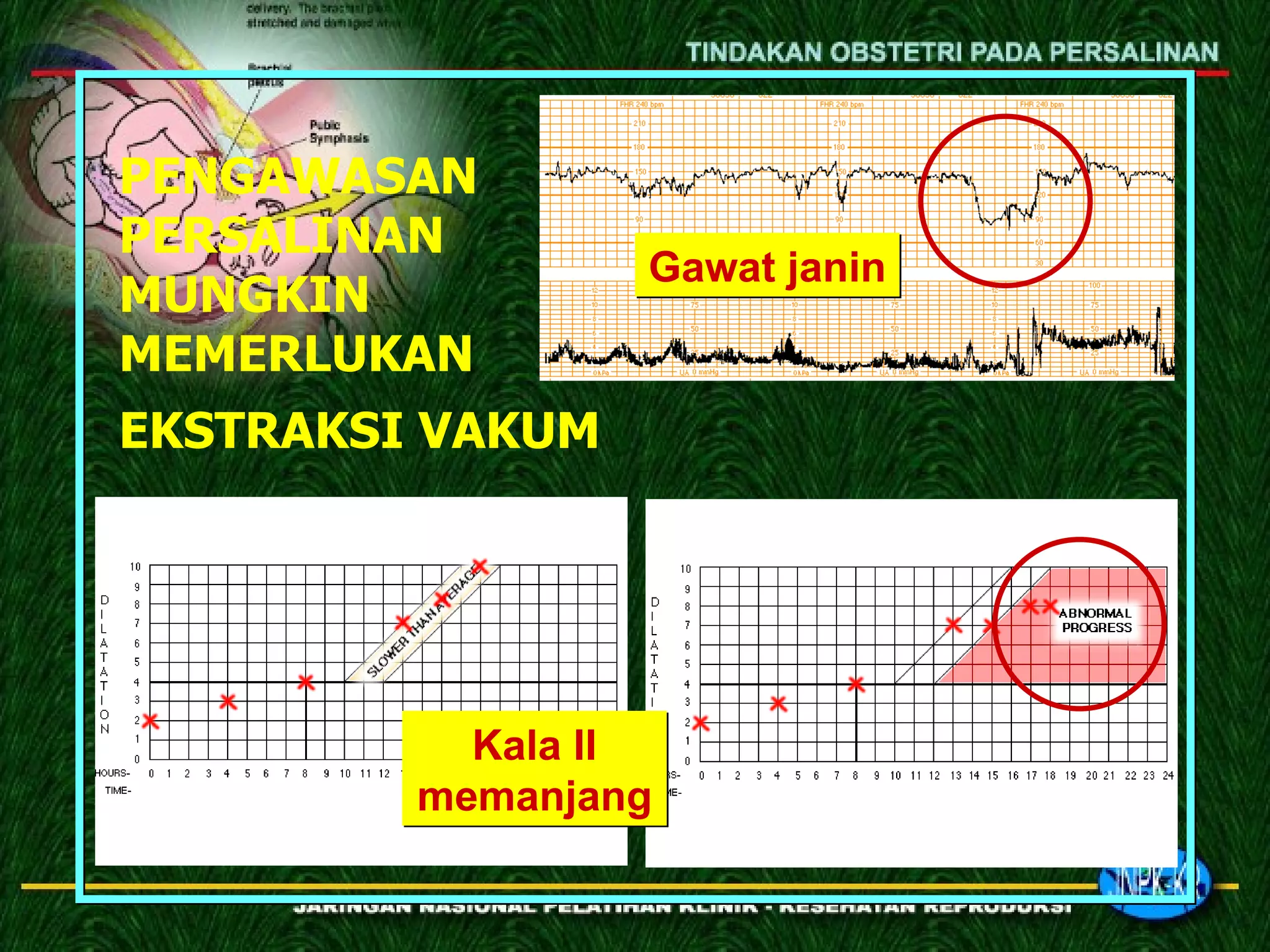 03 distosia bahu | PPT