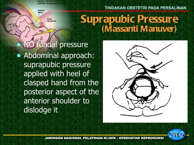 03 distosia bahu | PPT