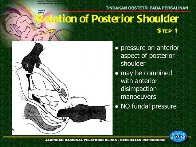 03 distosia bahu | PPT