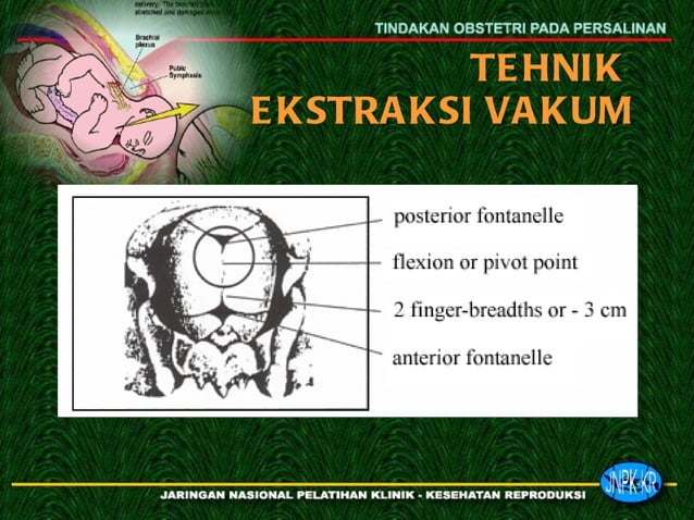 03 distosia bahu | PPT