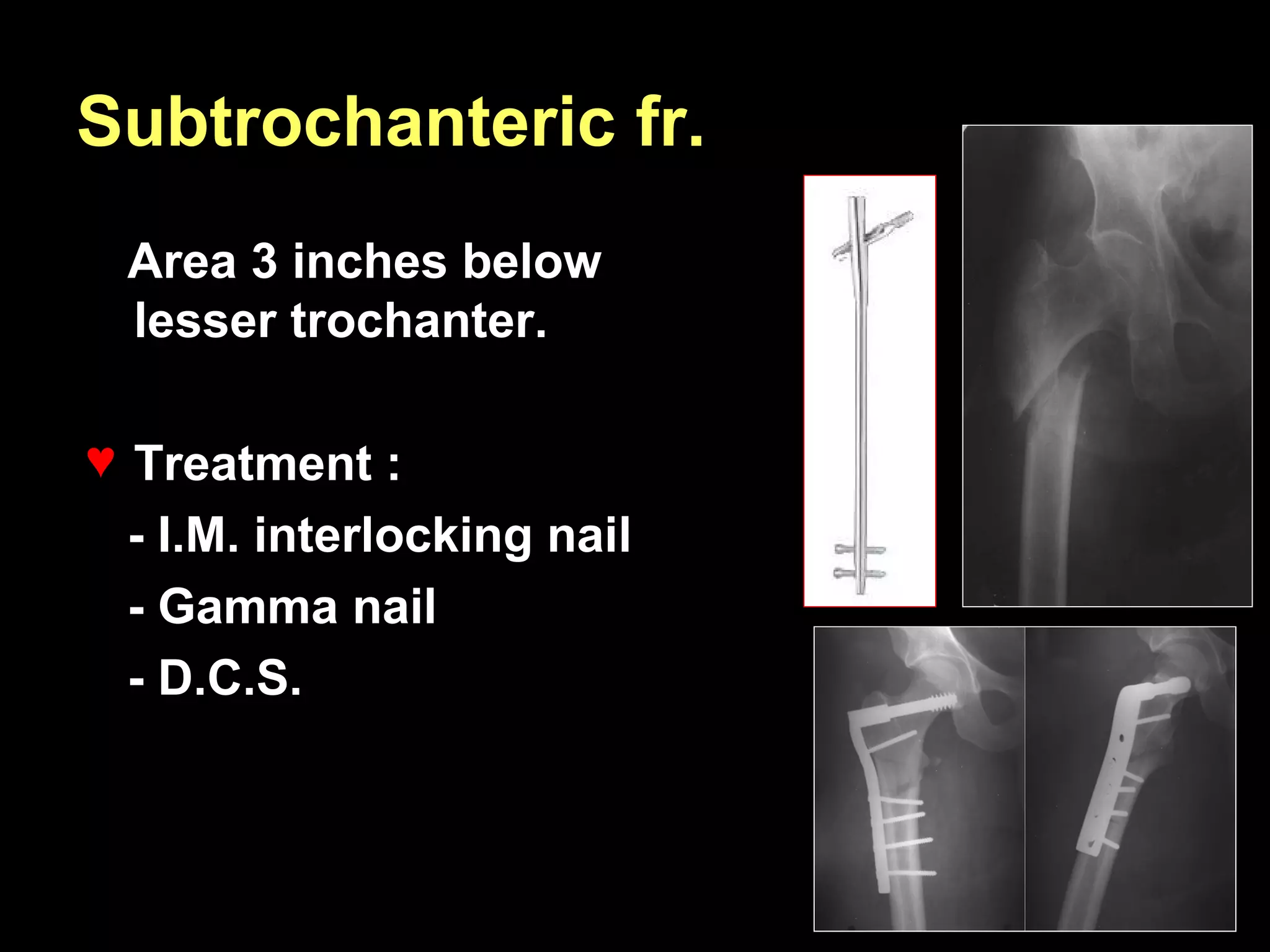 Fracture of Lower Limb and Pelvis | PPT