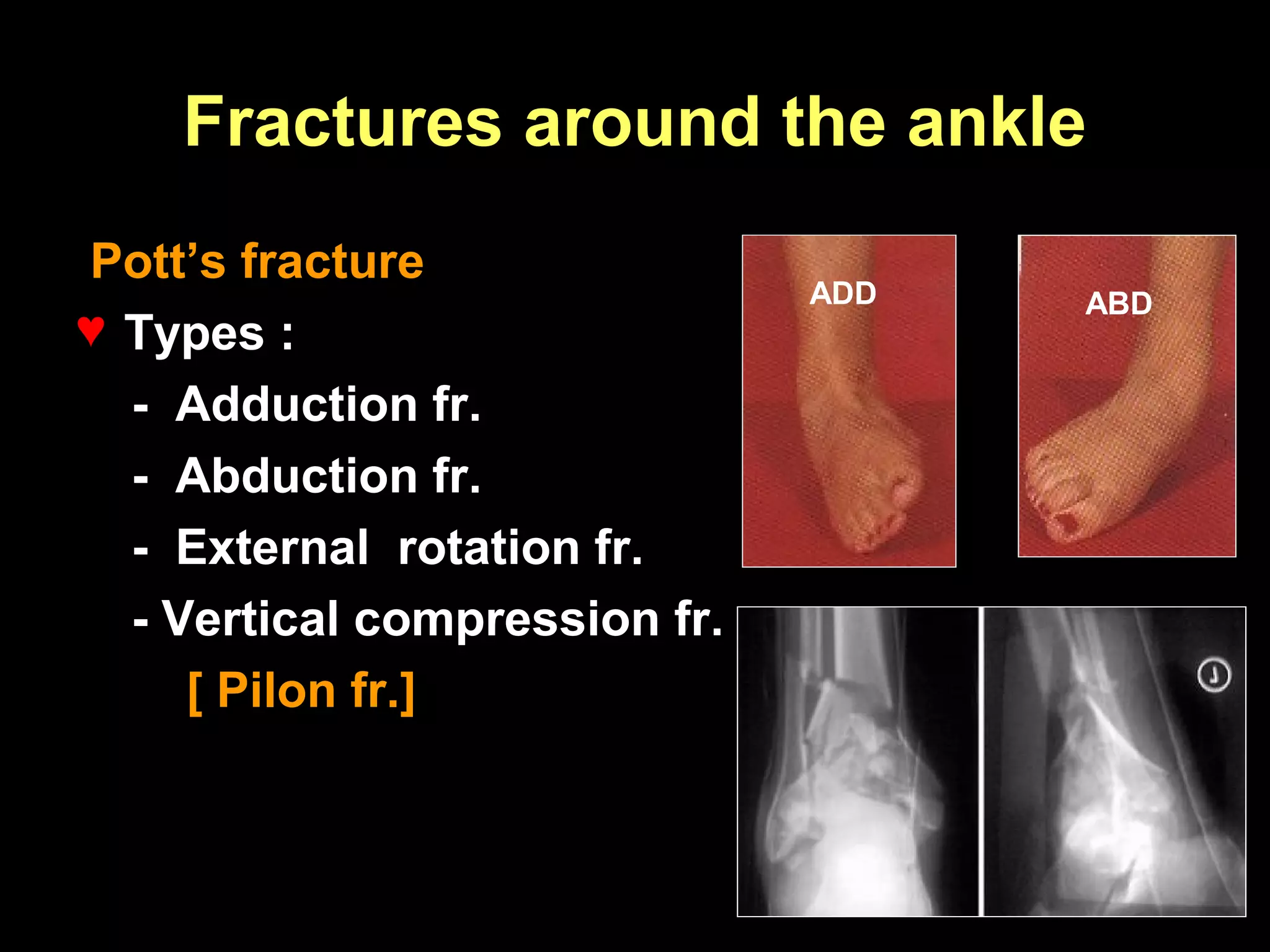 Fracture of Lower Limb and Pelvis | PPT