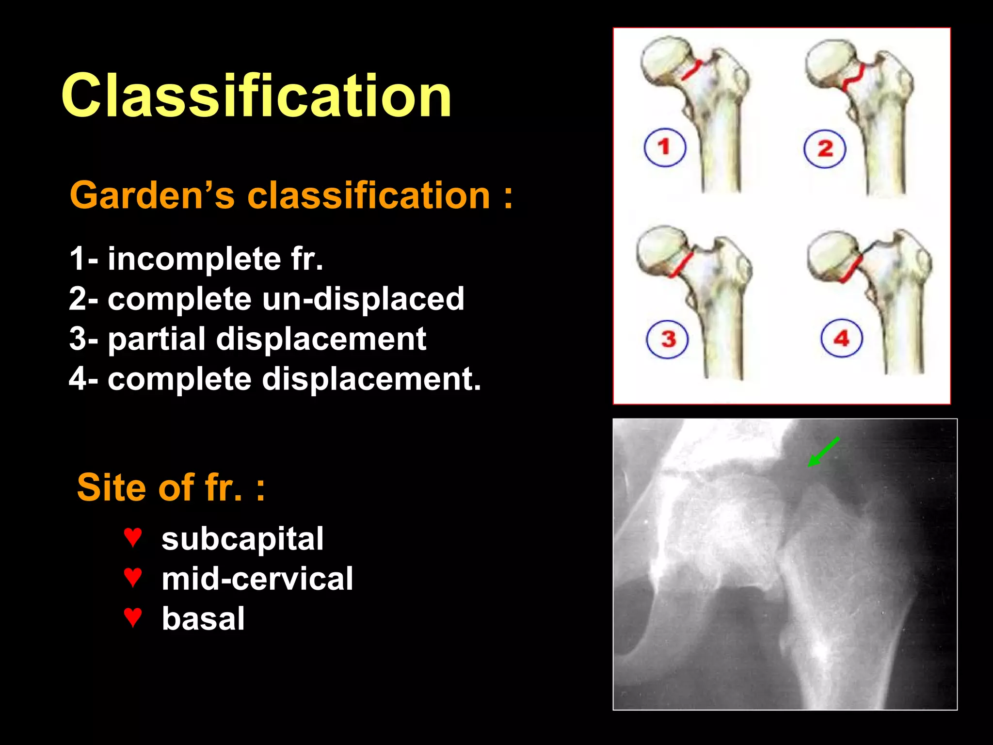 Fracture of Lower Limb and Pelvis | PPT