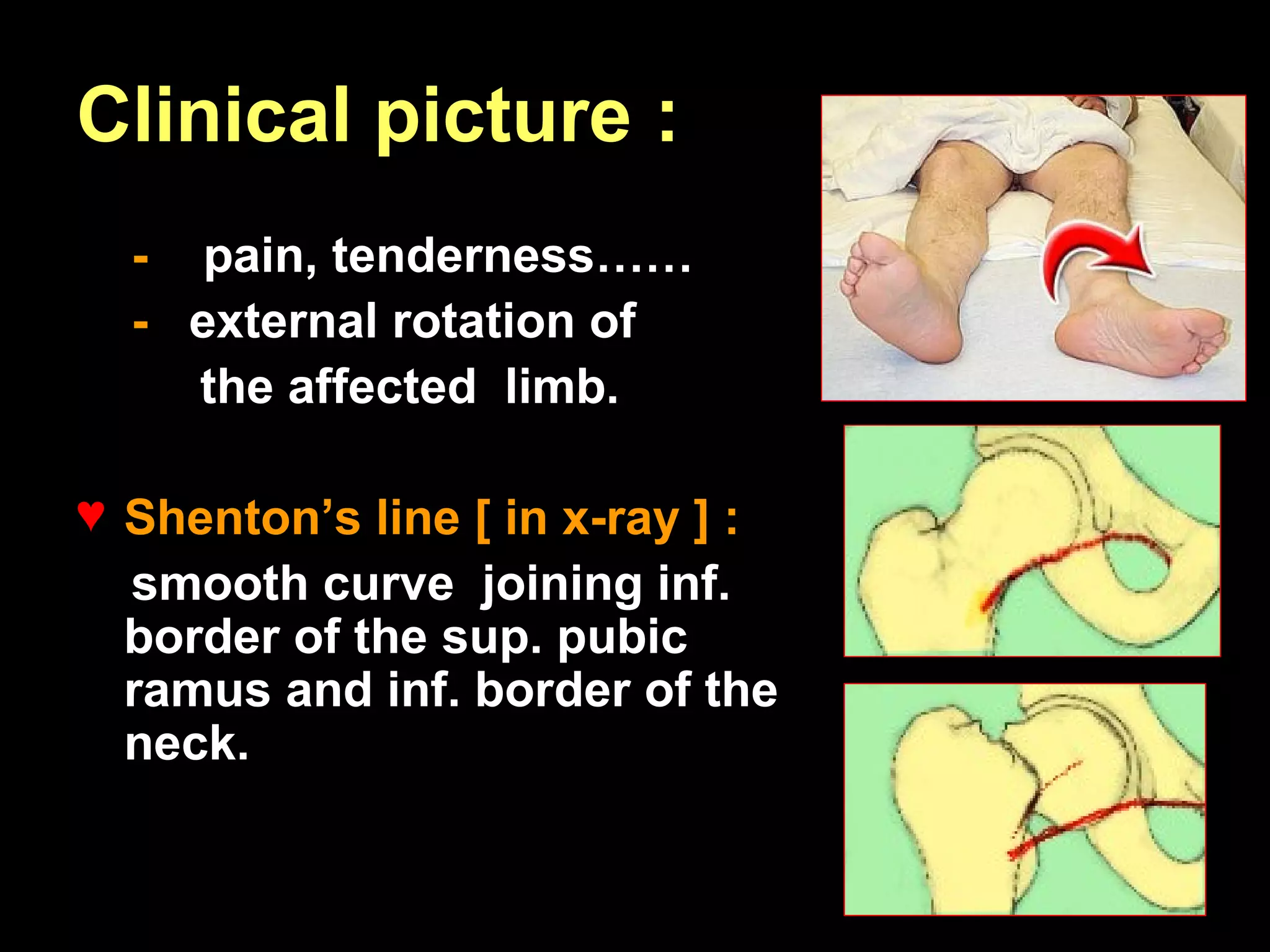 Fracture of Lower Limb and Pelvis | PPT