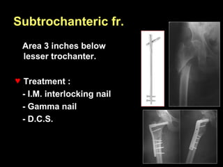 Fracture of Lower Limb and Pelvis | PPT