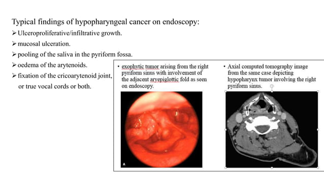 Management of carcinoma hypopharynx | PPTX