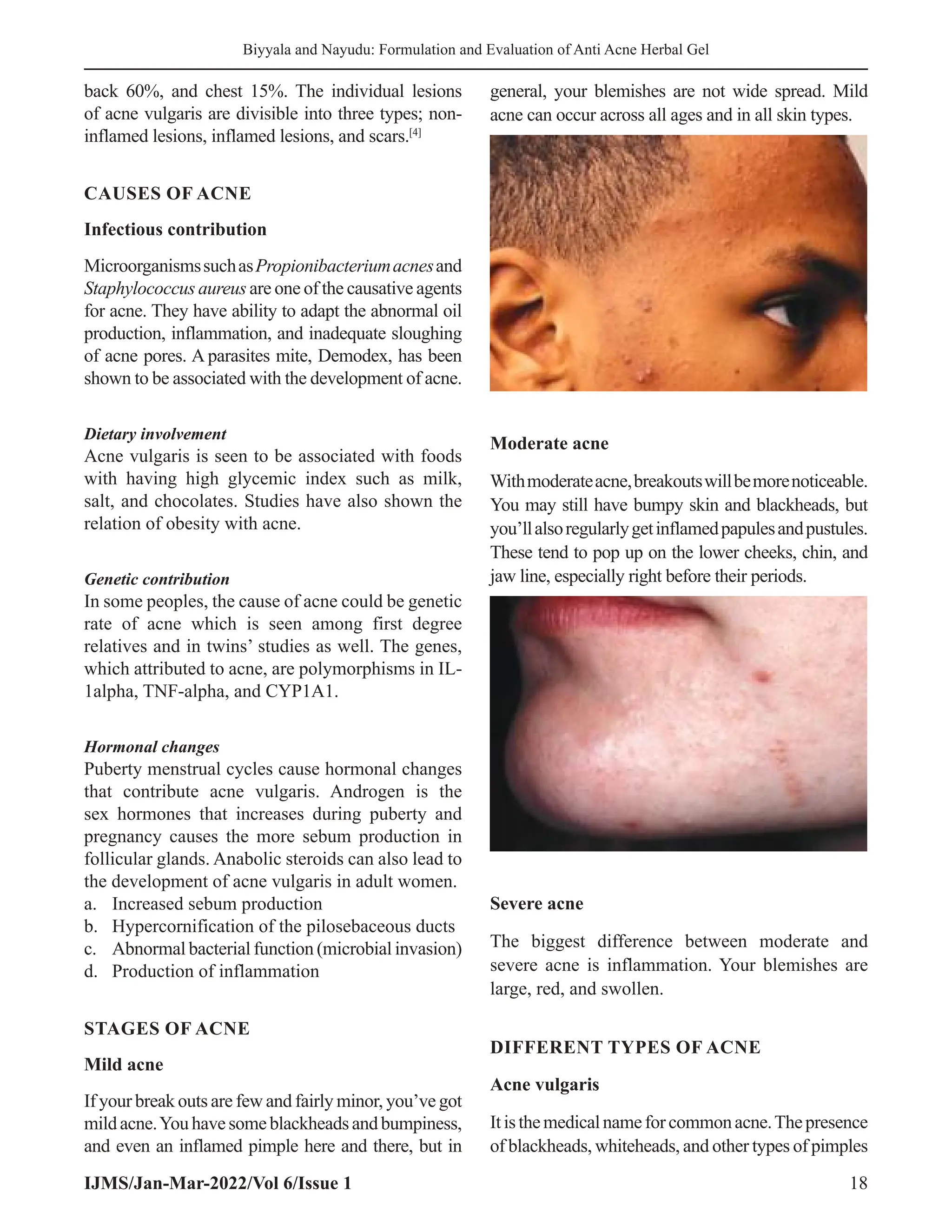 Formulation and evaluation of anti-acne herbal gel | PDF