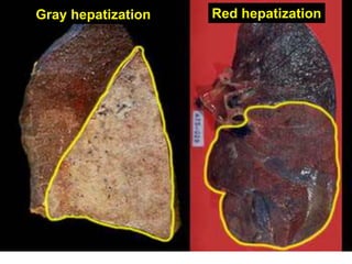 03 Respiratory infection1 | PPT