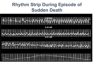 03 Samir Rafla-Sudden Cardiac Death and Resuscitation.ppt