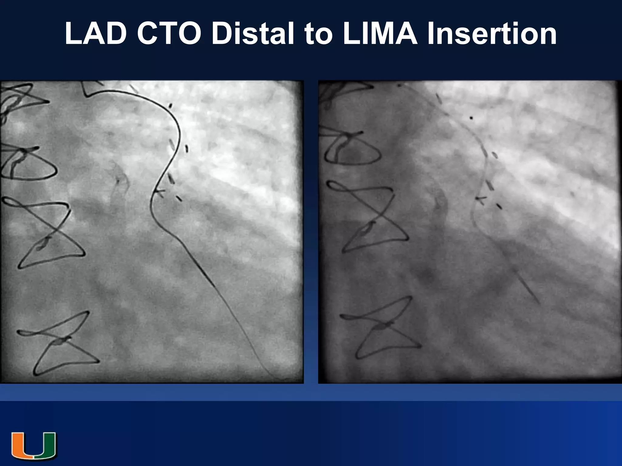 03 technical Cohen aimradial20170922 Guiding catheters | PPTX