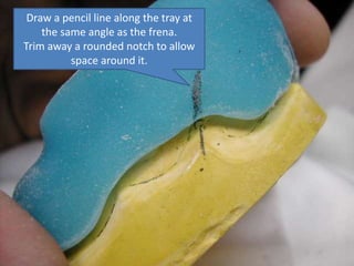 Upper partial special tray | PPTX | Oral care | Personal Care