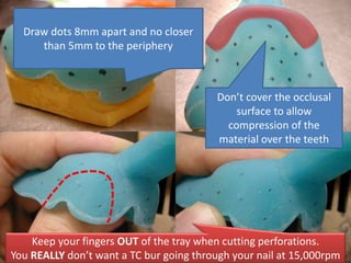 Upper partial special tray | PPTX