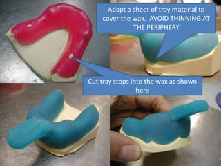 Upper partial special tray | PPTX