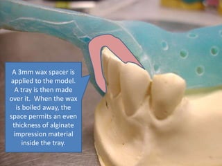 Upper partial special tray | PPTX