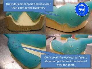 Upper partial special tray | PPTX