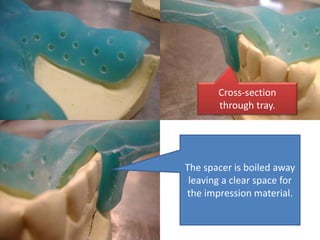 Upper partial special tray | PPTX