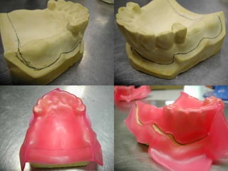 Upper partial special tray | PPTX