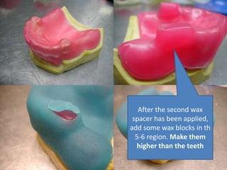 Upper partial special tray | PPTX