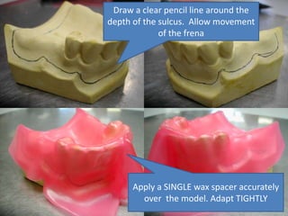 Upper partial special tray | PPT