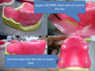 Upper partial special tray | PPTX