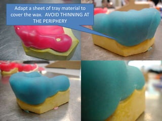 Upper partial special tray | PPTX