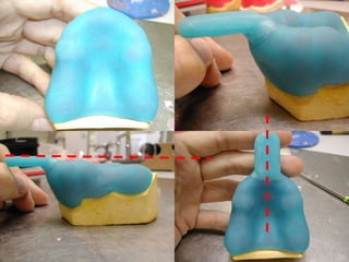 Upper partial special tray | PPTX