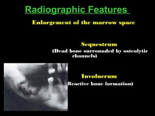 osteomyelitis & osteoradionecrosis | PPT