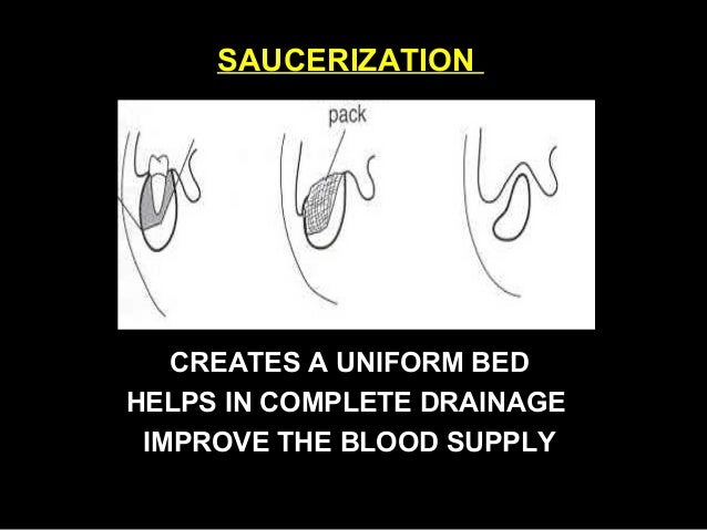 osteomyelitis & osteoradionecrosis