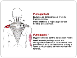 Dolor Muscular Trapecio