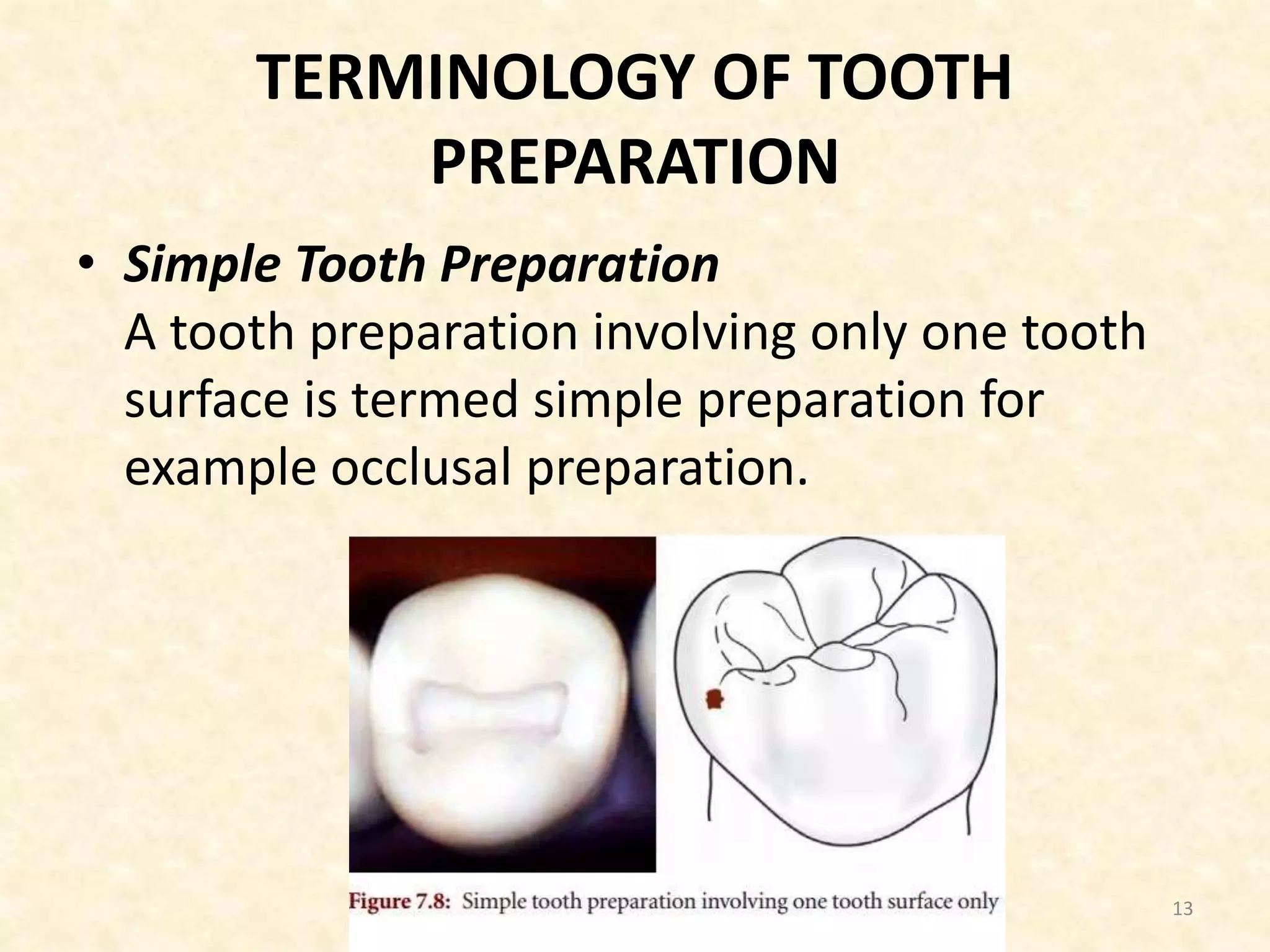 04.principles of tooth preparation | PPTX