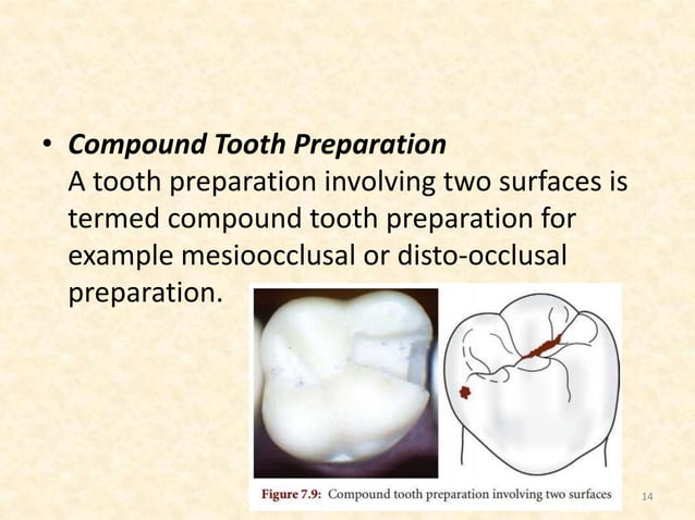 04.principles of tooth preparation | PPTX | Dental Health | Diseases and Conditions
