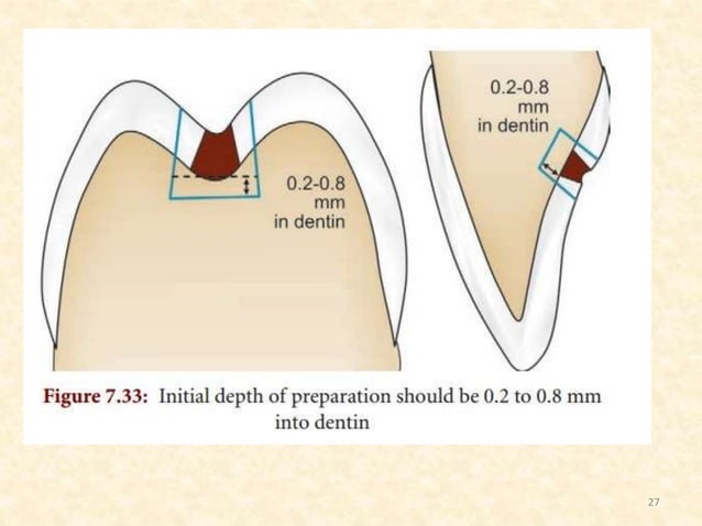 04.principles of tooth preparation | PPTX | Dental Health | Diseases ...