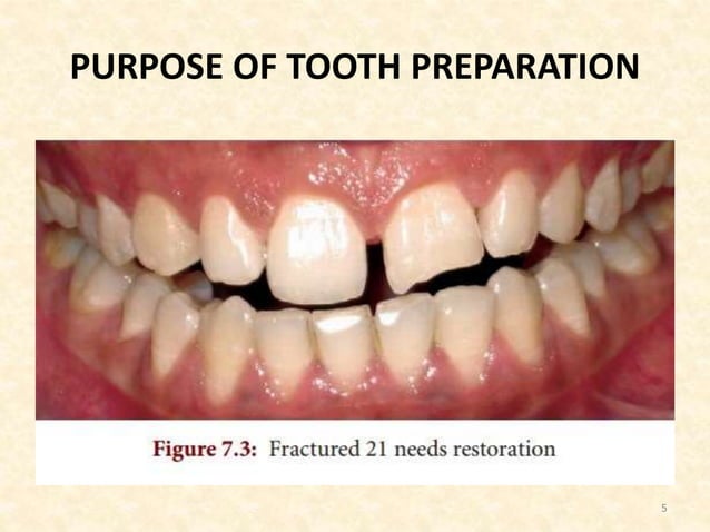 04.principles of tooth preparation | PPTX | Dental Health | Diseases and Conditions