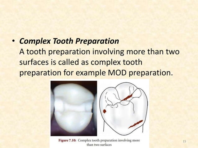 04.principles of tooth preparation | PPT
