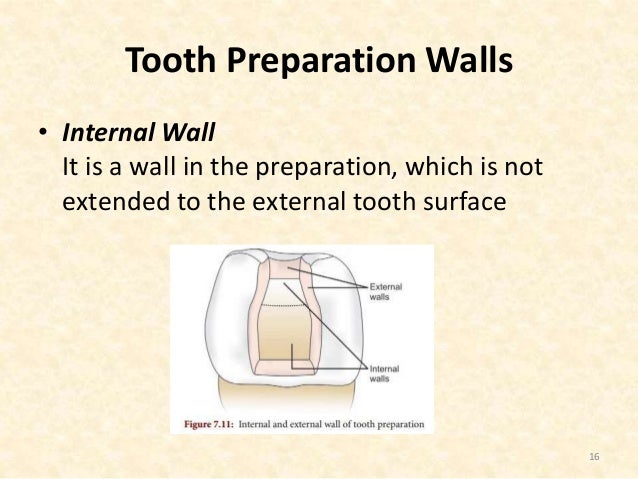 04.principles of tooth preparation