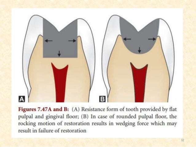 04.principles of tooth preparation
