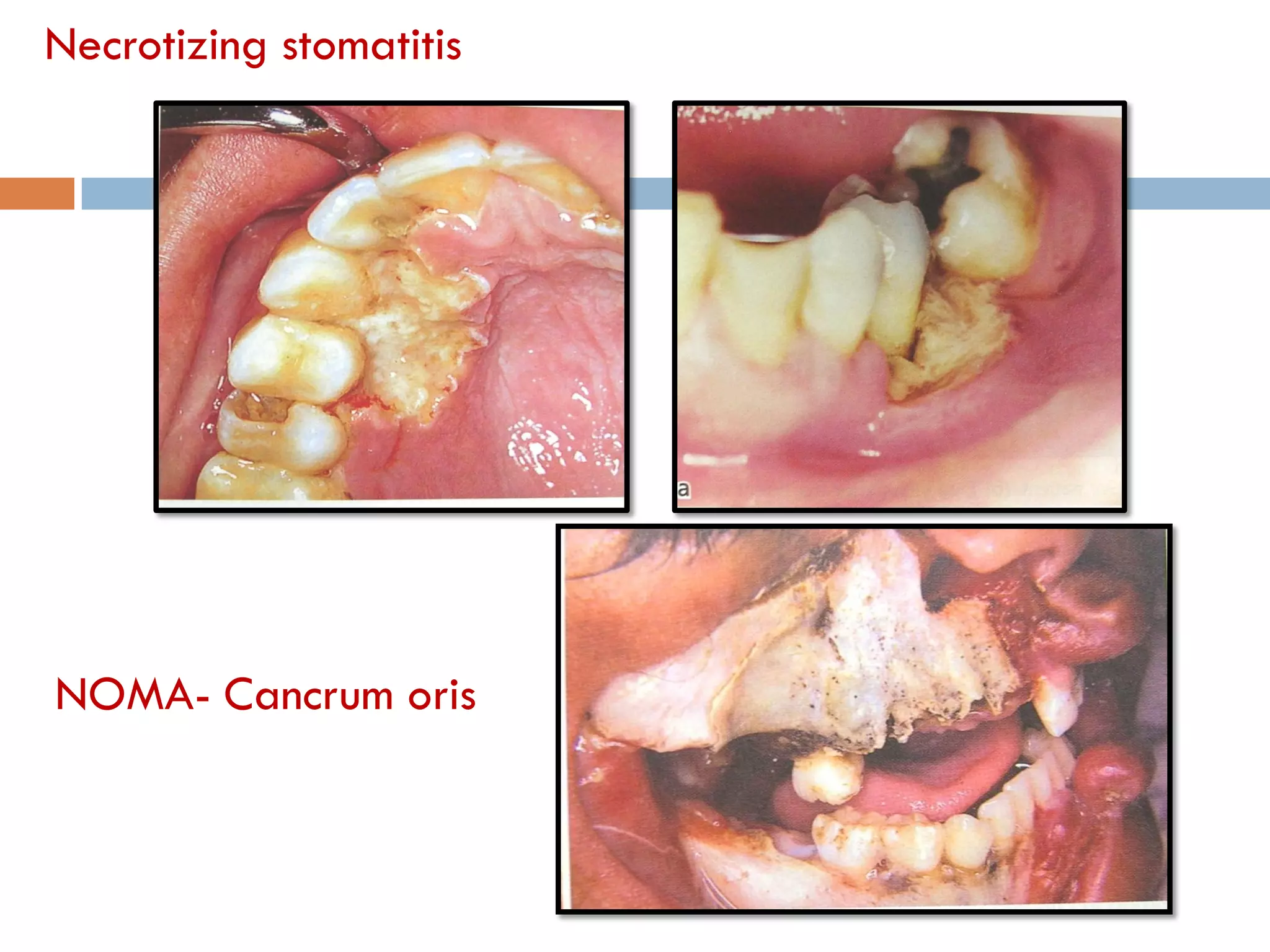 04.acute gingival infections | PDF