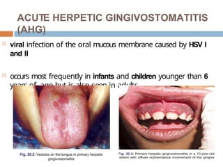 Gingival infections Gingival infections Gingival infections | PPT