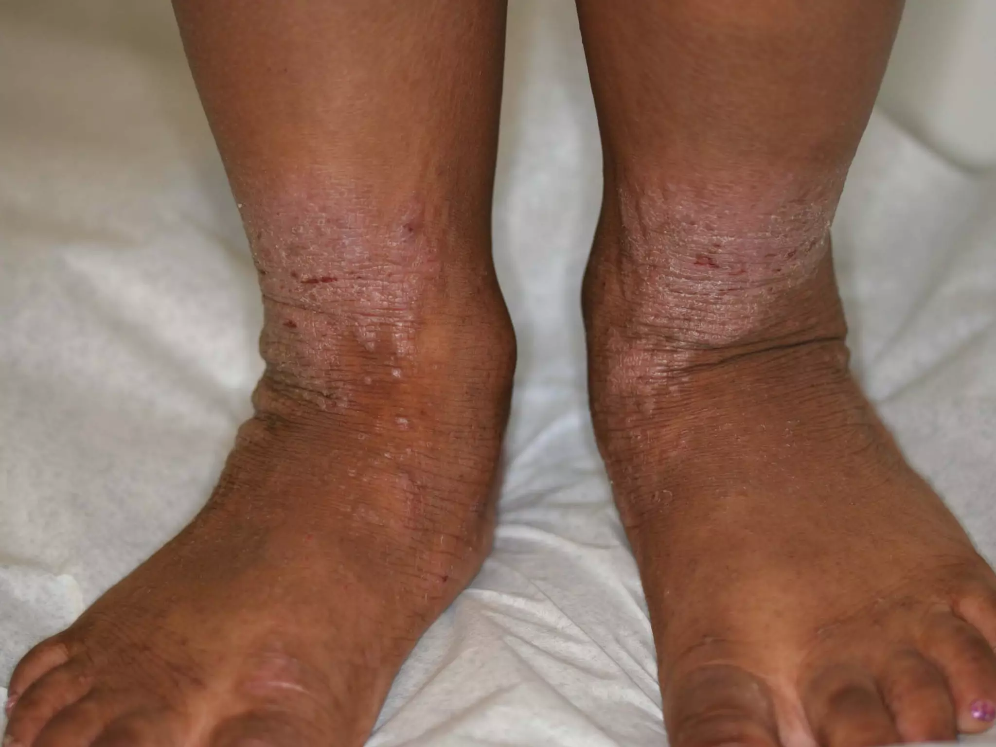 04. Common Pediatric Dermatology Diagnoses (Power Point Presentation ...