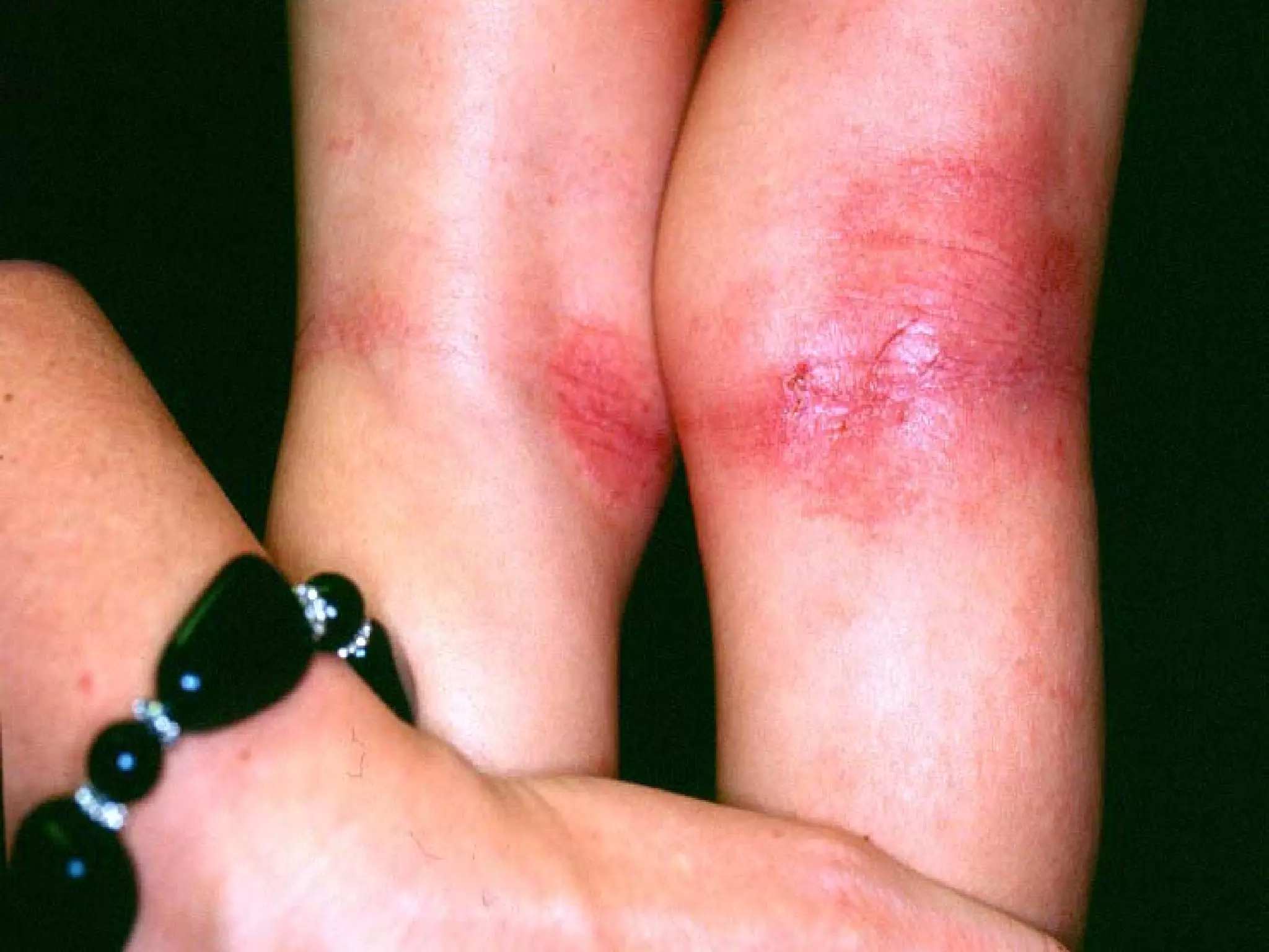 04. Common Pediatric Dermatology Diagnoses (Power Point Presentation ...