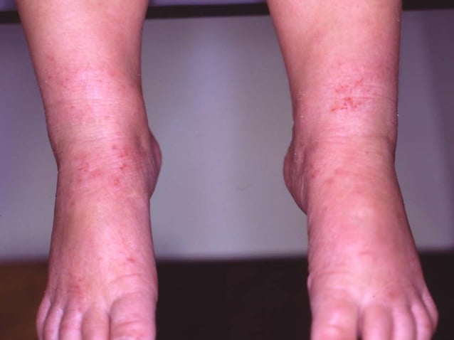 04. Common Pediatric Dermatology Diagnoses (Power Point Presentation ...