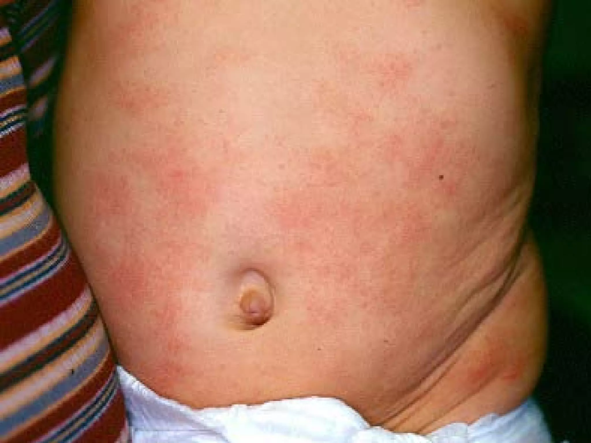 04. Common Pediatric Dermatology Diagnoses (Power Point Presentation ...