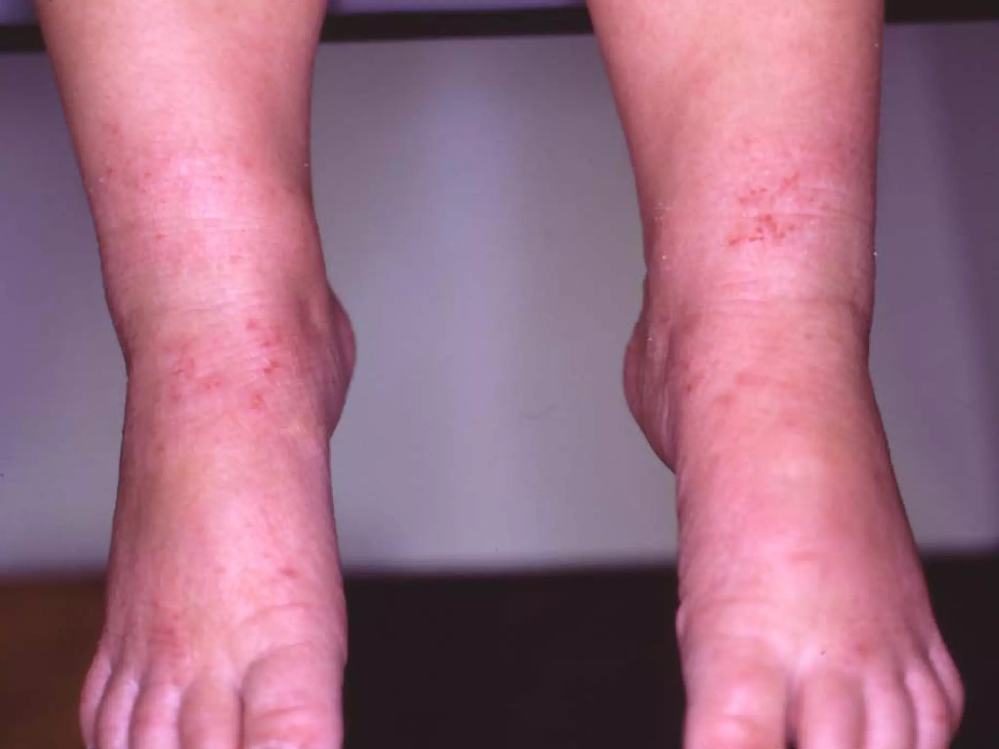 04. Common Pediatric Dermatology Diagnoses (Power Point Presentation ...