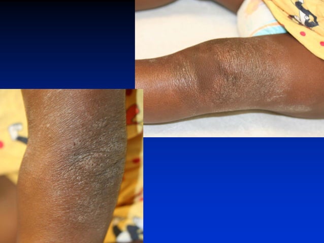 04. Common Pediatric Dermatology Diagnoses (Power Point Presentation ...