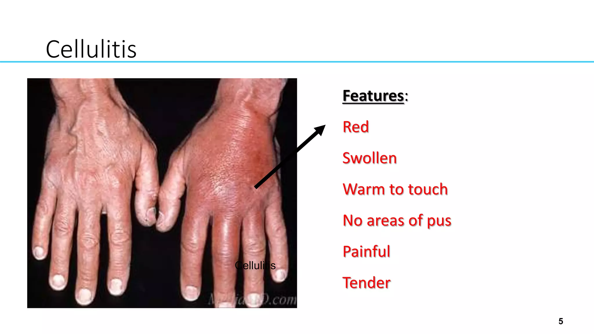 04. cellulitis.ppt