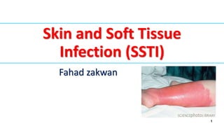04. cellulitis.ppt